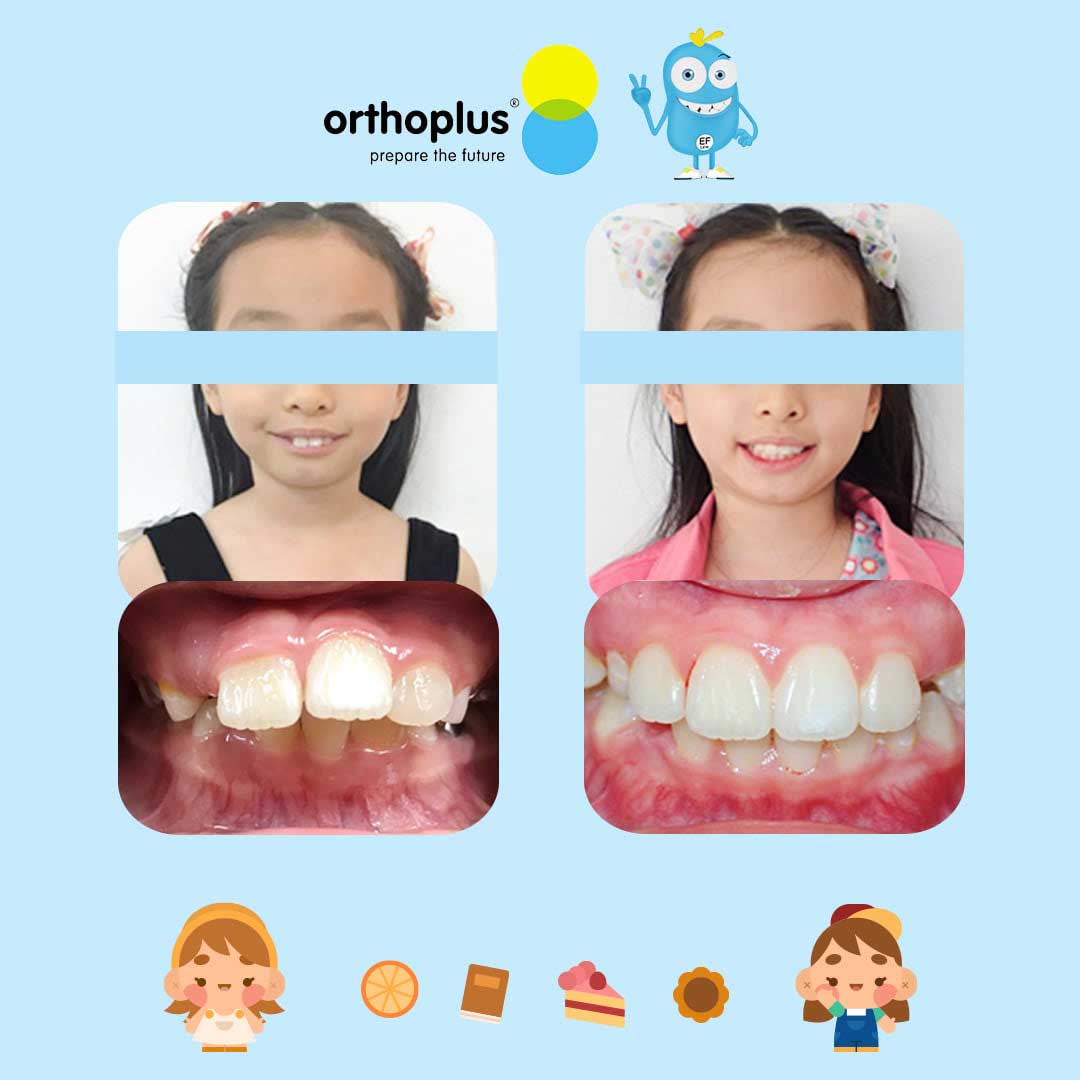 4 คำถามที่พบบ่อยเกี่ยวกับ EF Line - 24Dent